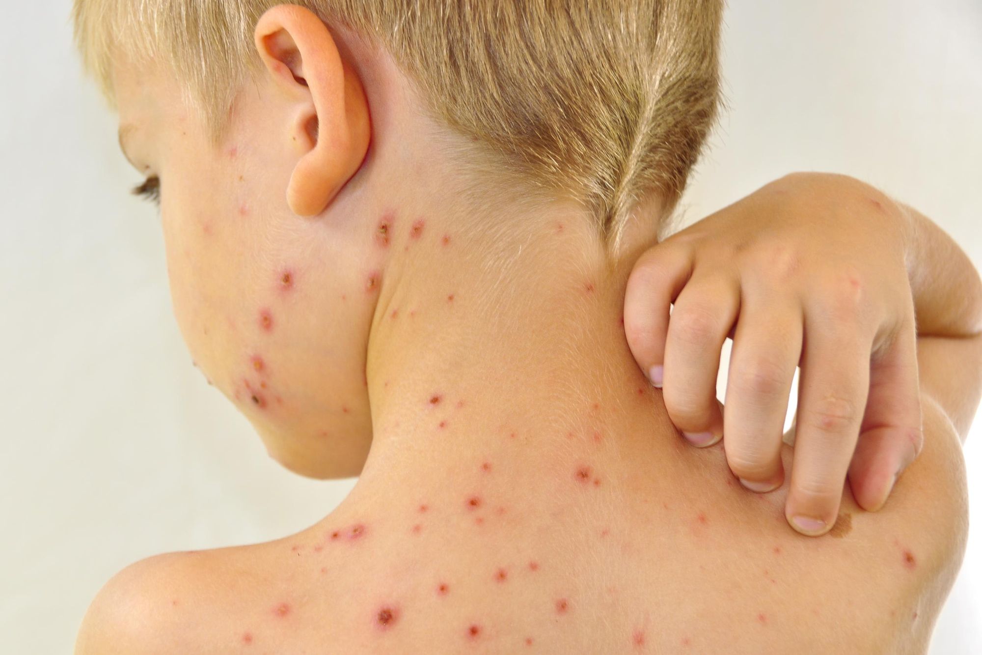 Rougeole à Laval: au moins deux lieux possibles de contagion